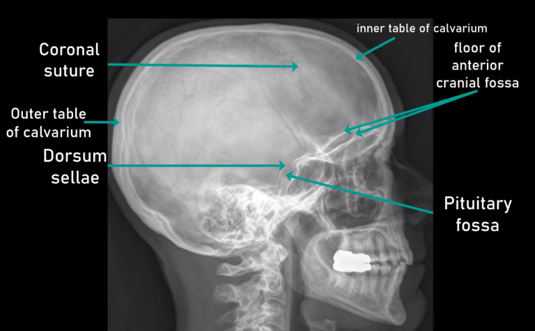 Lateral Skull X-ray Guide: Radiologist's Handbook - HSIN FILM