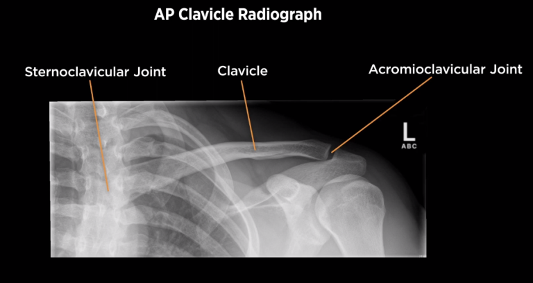 Clavicle X-ray Positioning in Radiography: Cracking the Code - HSIN FILM