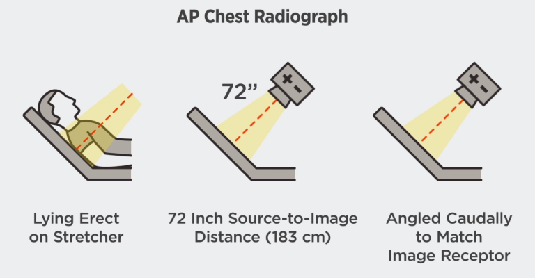 A Full Radiologist Guide on Lordotic Chest X-ray - HSIN FILM