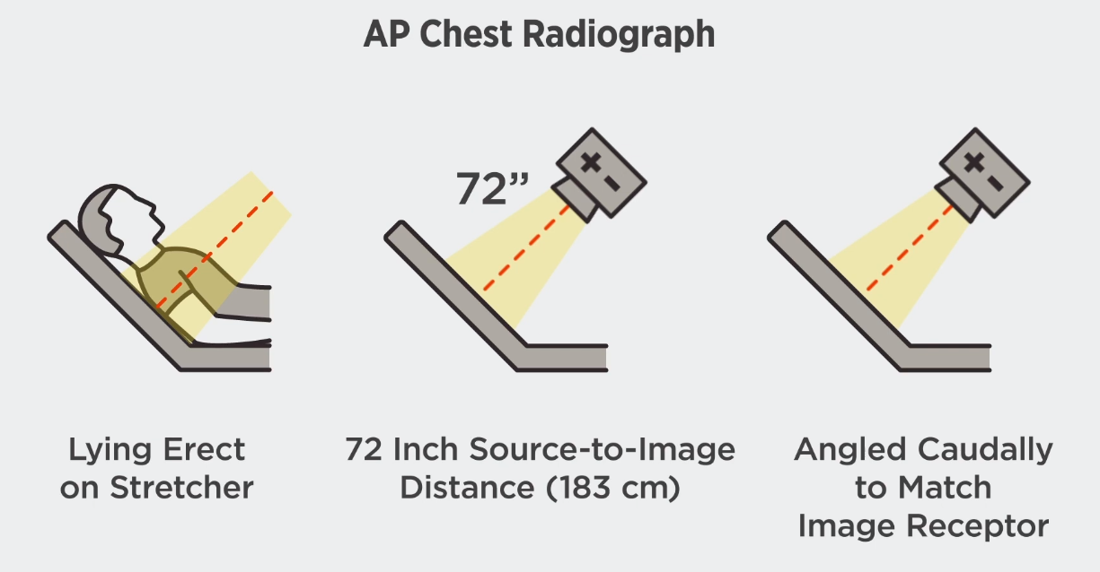 A Full Radiologist Guide on Lordotic Chest X-ray - HSIN FILM