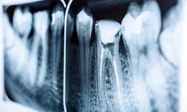 A Comprehensive Guide Through Root Canal X-rays - HSIN FILM