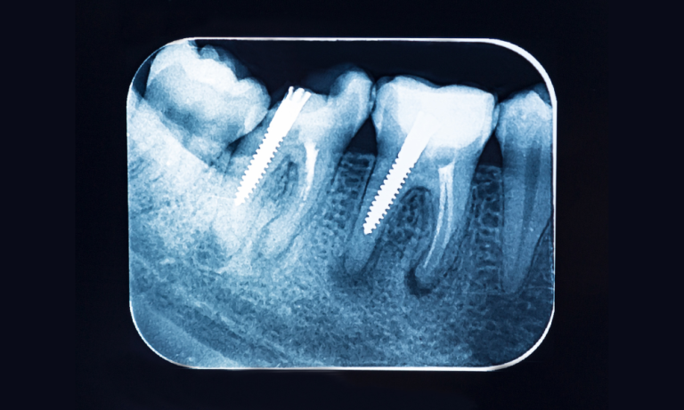 A Comprehensive Guide Through Root Canal X-rays - HSIN FILM