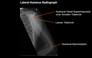 Optimal Lateral Humerus X-rays Positioning: The Radiographer's Guide ...