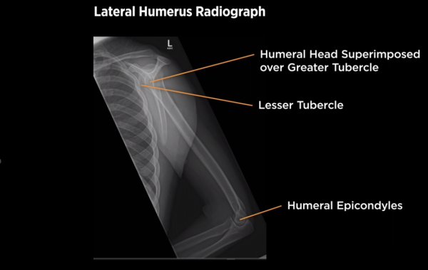 Optimal Lateral Humerus X-rays Positioning: The Radiographer's Guide ...